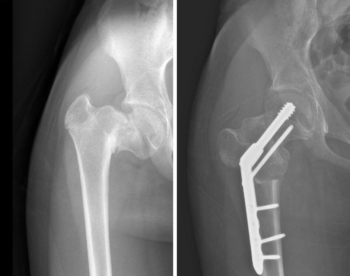 USA Health pediatric orthopaedic surgeon first in state to use new hip ...